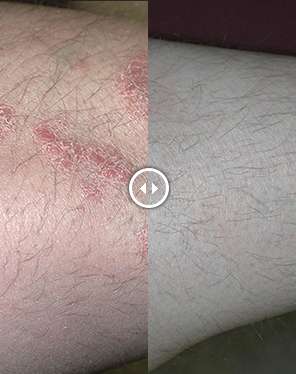 XTRAC Laser Psoriasis Treatment