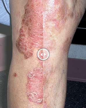 XTRAC Laser Psoriasis Treatment