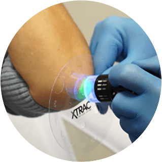 XTRAC Laser Psoriasis Treatment