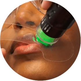 XTRAC Laser Vitiligo Treatment
