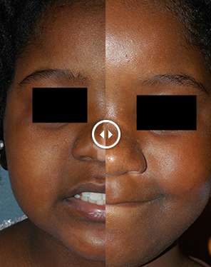 XTRAC Laser Vitiligo Treatment