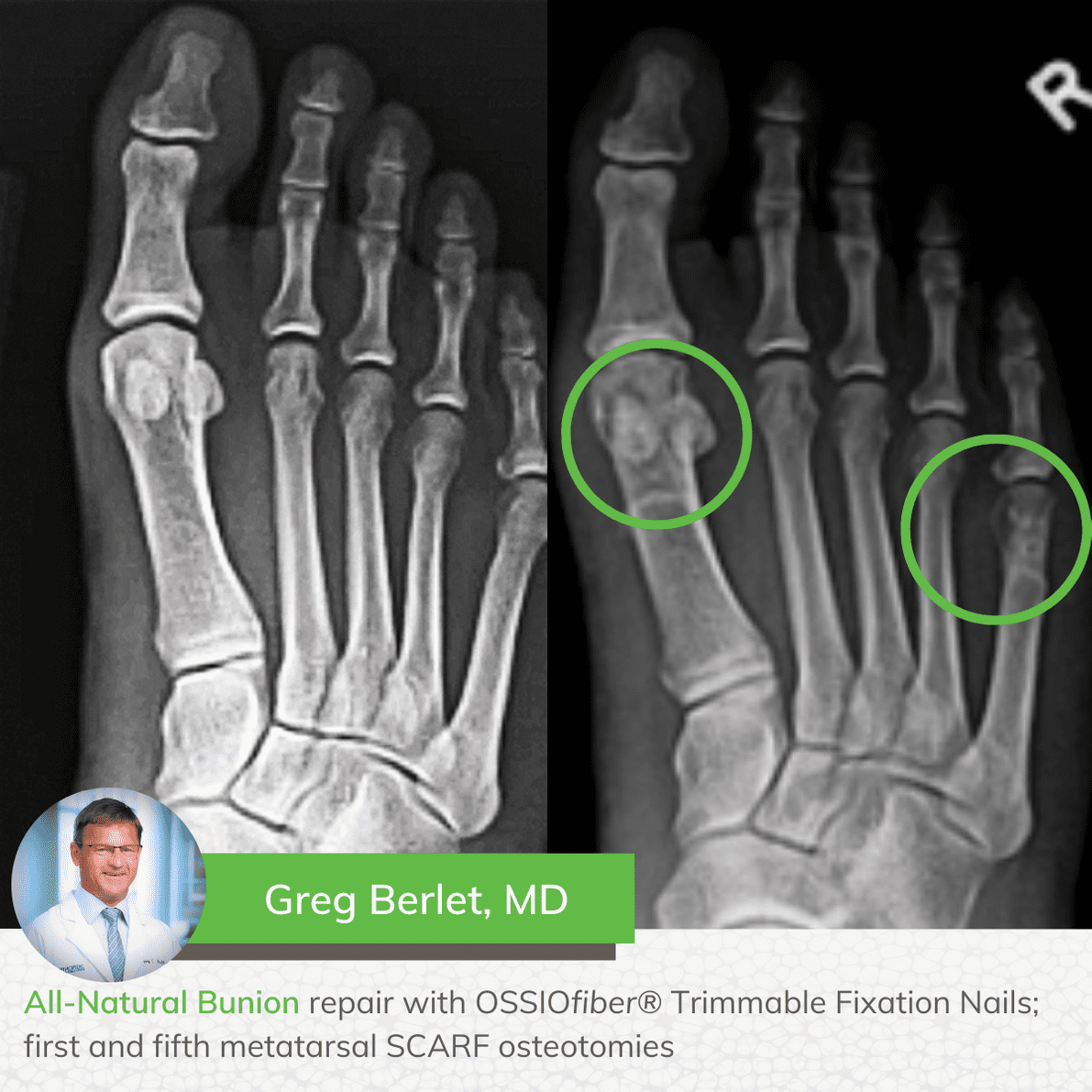 OSSIOfiber All Natural Bunion