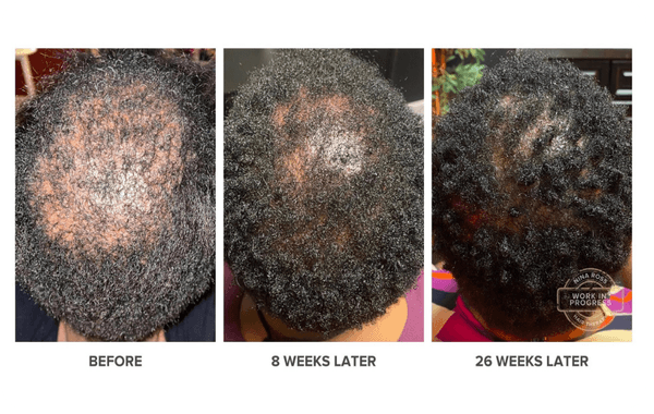 This patient had Alopecia Areata