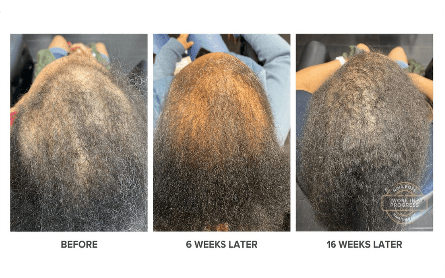 This patient has Hormonal Hair Loss