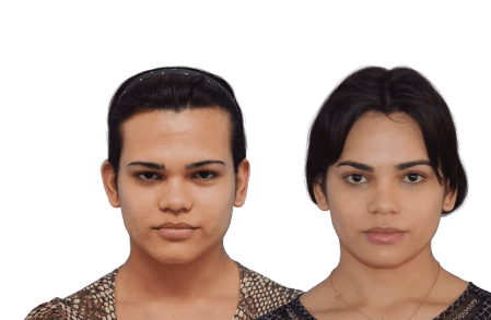 Facial feminisation surgery for transgender women