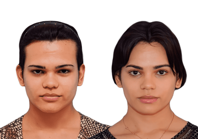 Facial feminisation surgery for transgender women