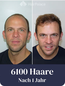 Hochwertige Haartransplantation in Ungarn