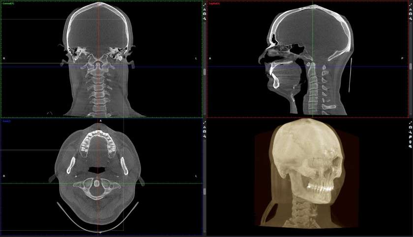 Planmeca Viso family of CBCT 3D imaging systems