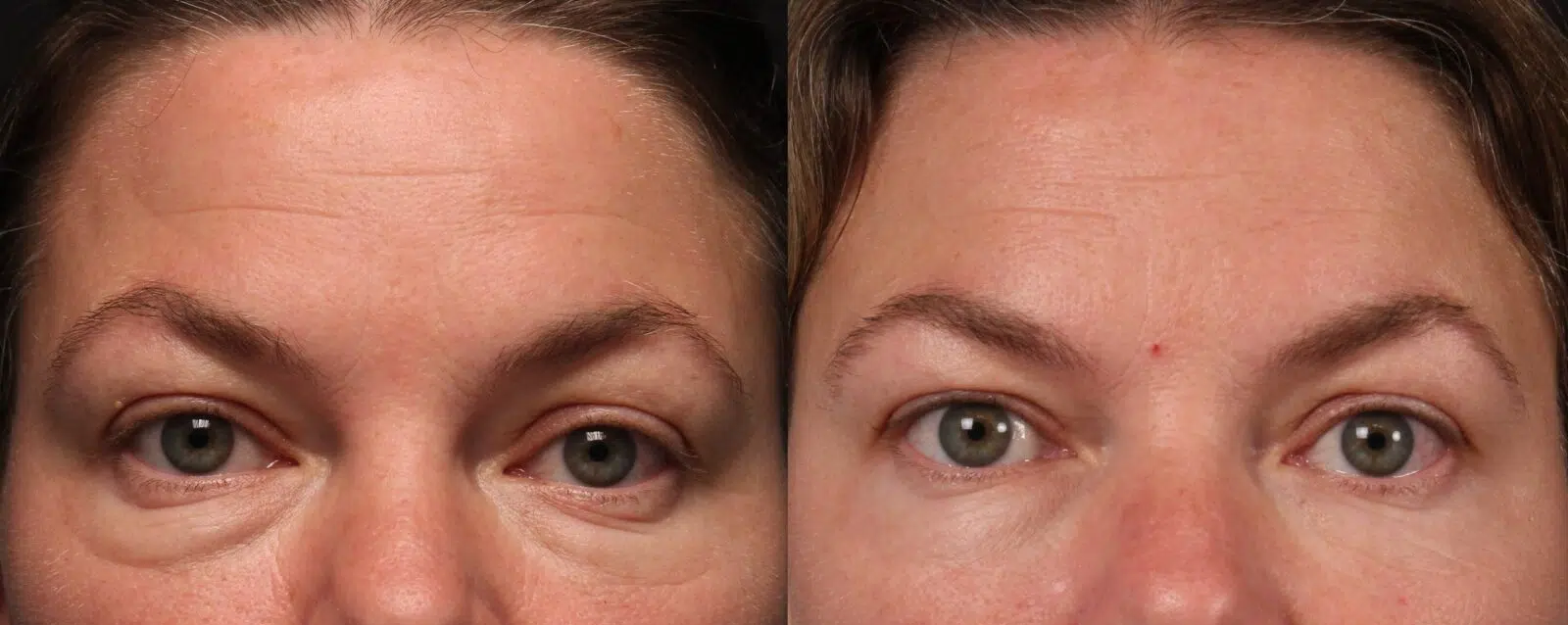 Morpheus8 Eye Consultation | Mitchell Eye Centre