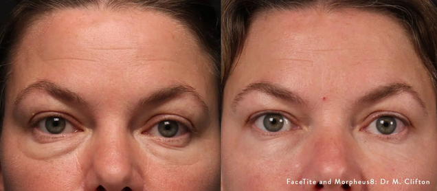 Morpheus8 Eye Consultation | Mitchell Eye Centre