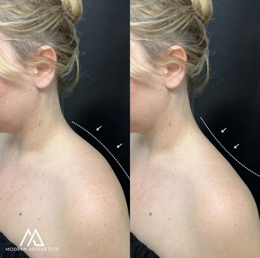 Trap Botox with Dr. Anwar