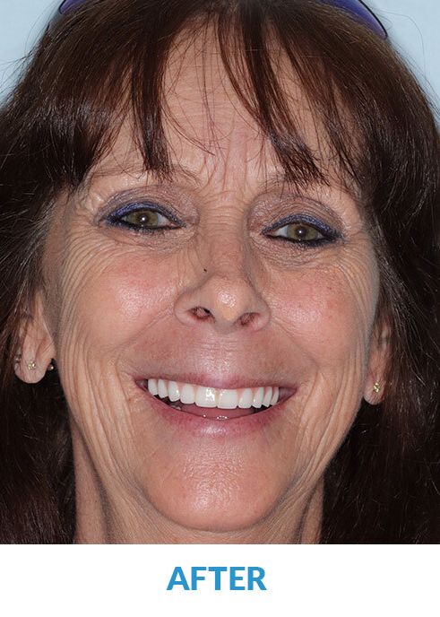 Next Step Smiles Dental Implant Center