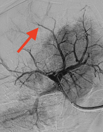 Northwestern Medicine CTEPH