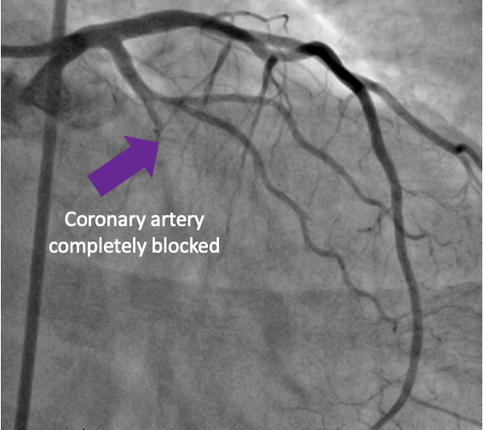Northwestern Medicine CTO Treatment