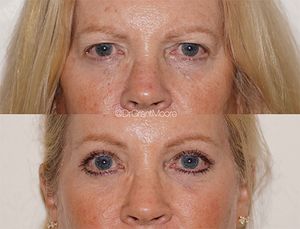 Dr. Grant Moore - Oculoplastic Surgeon in Scottsdale, Tucson, Phoenix ...