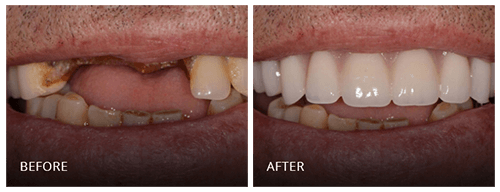 Dental Implant - Pacific Northwest Dental Office of Beaverton