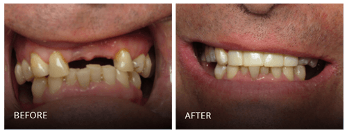 Dental Implant - Pacific Northwest Dental Office of Beaverton