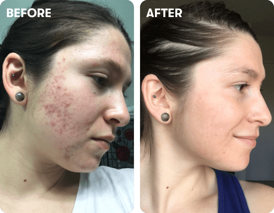 because i have clear skin my outside now reflects my inside