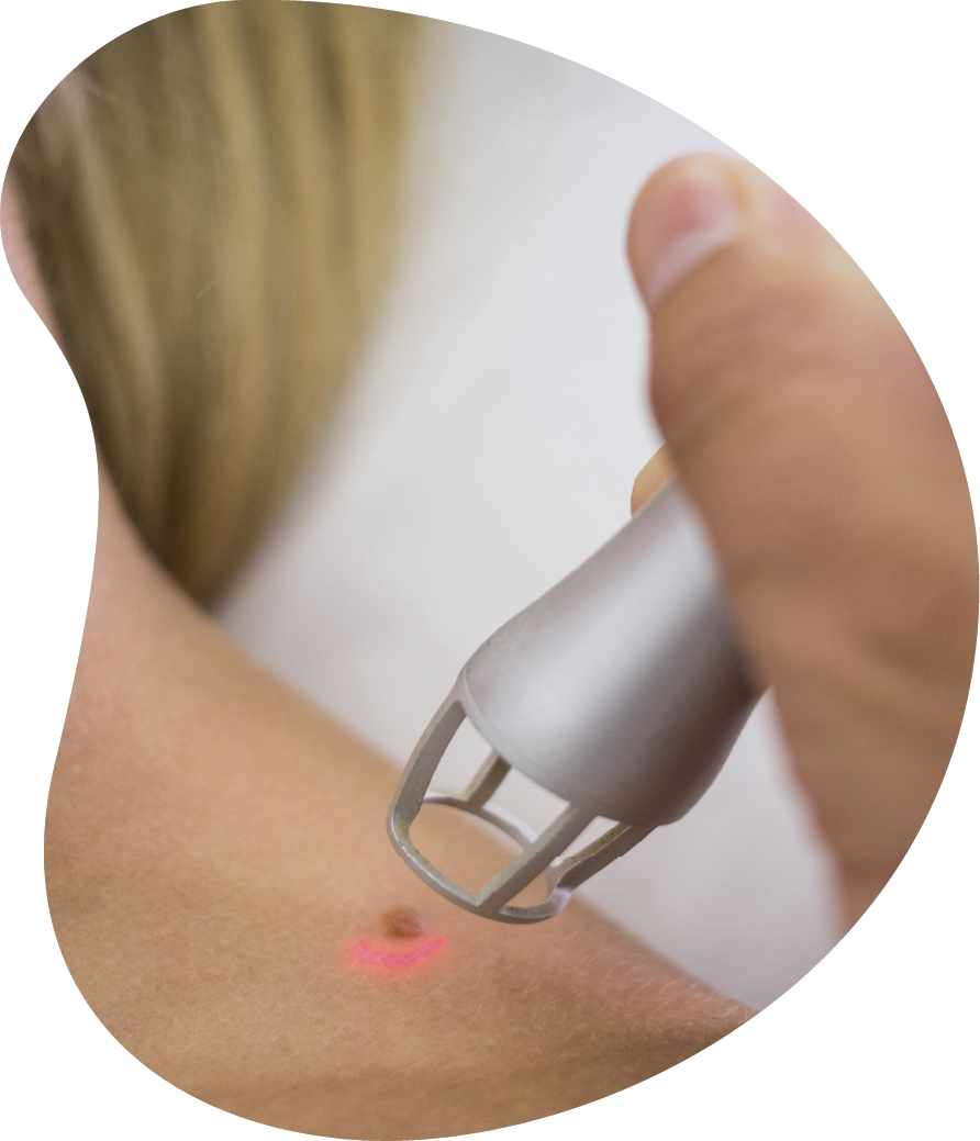 The UK s Leading Skin Tag Removal Clinics The UK s Leading Skin Tag Removal Clinics