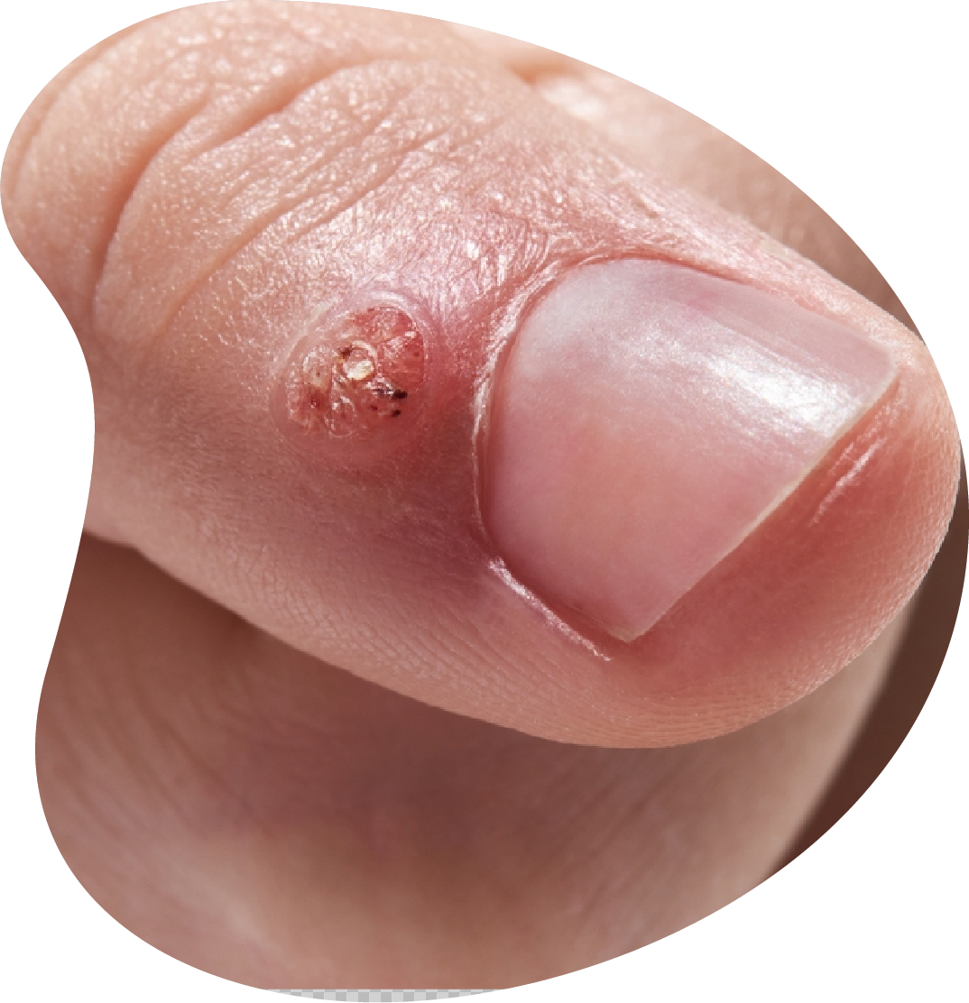 Glasgow's Leading Dermatology Clinic for Effective Wart Removal