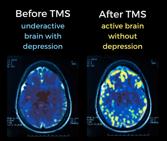 You Can Feel Better from Depression | Greenbrook TMS