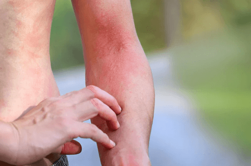 usually caused by specific triggers rashes may be annoying ...