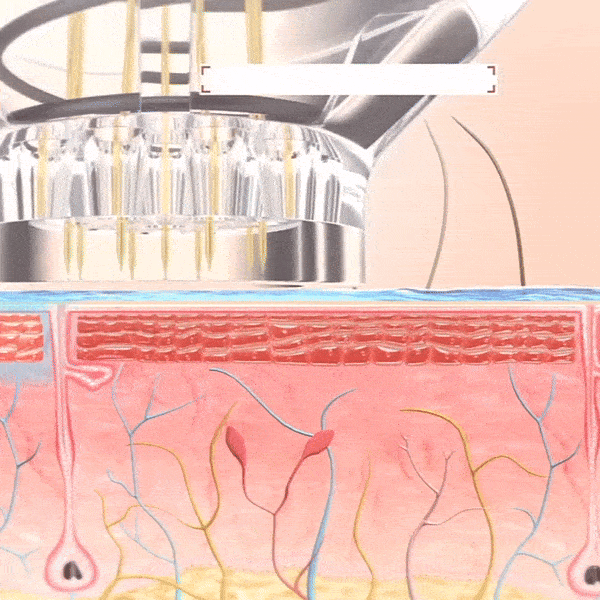 This is a non-invasive, at-home treatment that has dramatically boosted ...