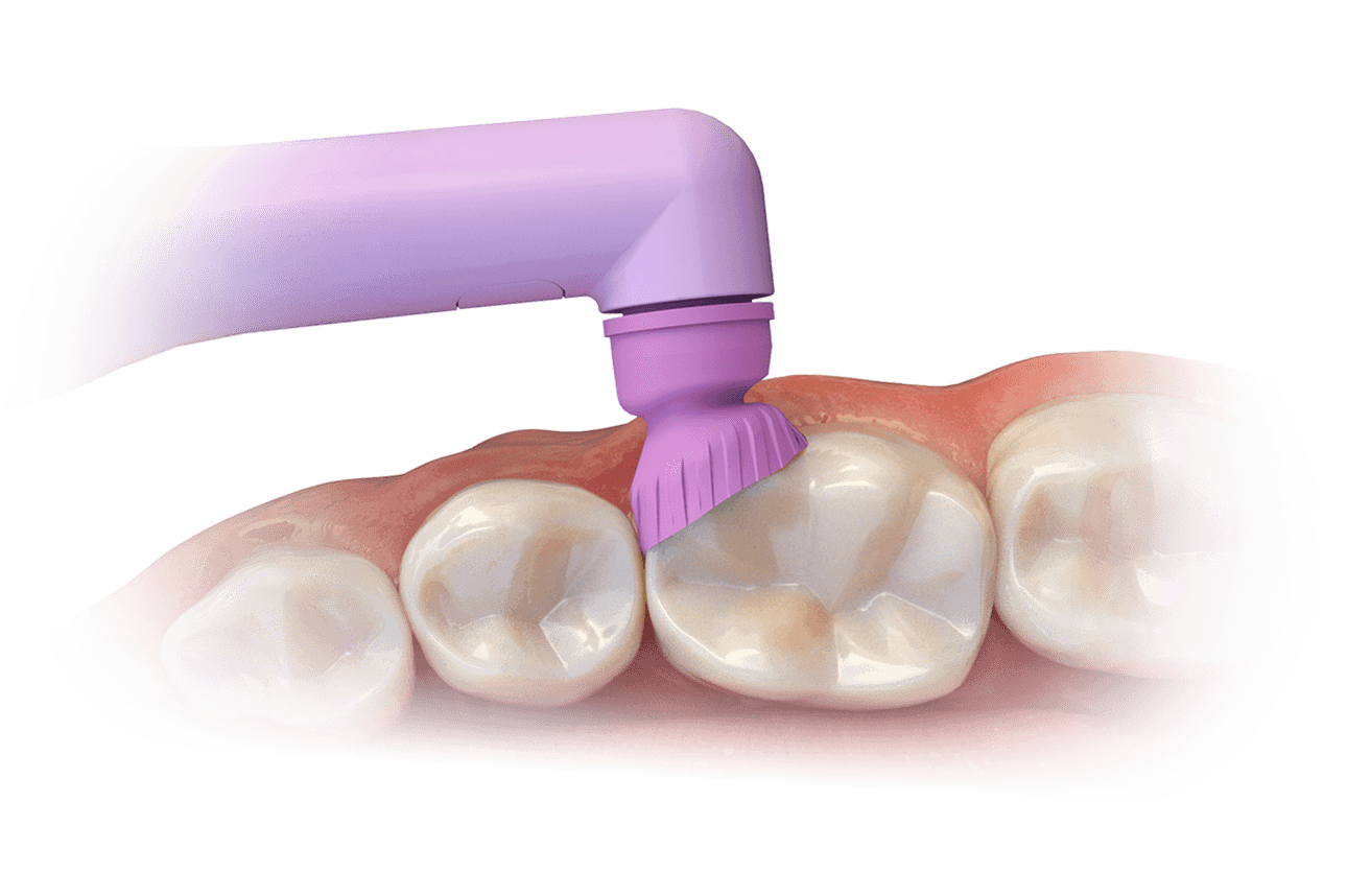 New! ProFlare Articulating Disposable Prophy Angle