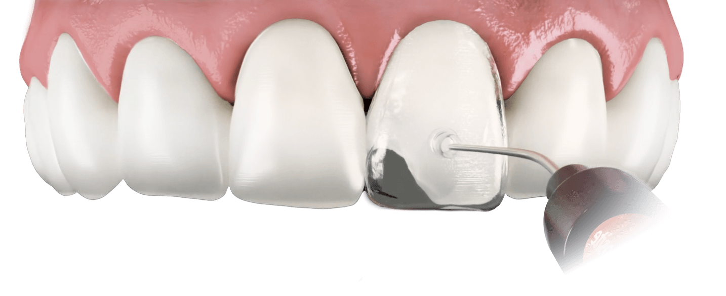 VeneerNow - the time to rethink composite veneers is NOW!