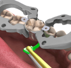 Premier X5 Sectional Matrix System - Try it for yourself