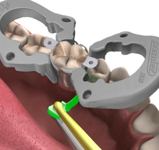 Premier X5 Sectional Matrix System - Try it for yourself