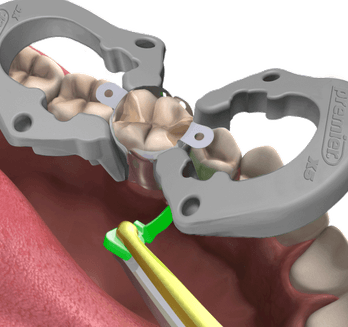 Premier X5 Sectional Matrix System - Try it for yourself