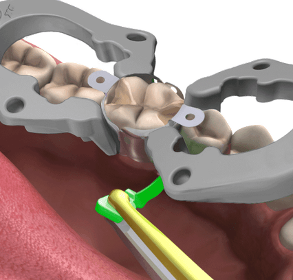 Premier X5 Sectional Matrix System - Try it for yourself