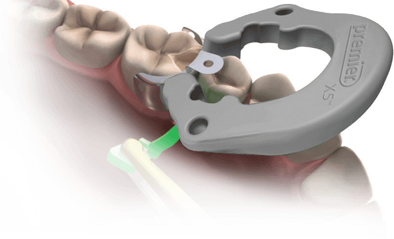 Premier X5 Sectional Matrix System - Try it for yourself