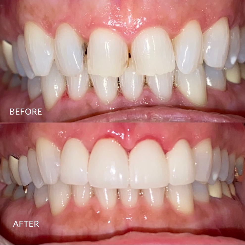 Dental Implant Step1 - Winchester Smiles of Virginia Family Dental Center
